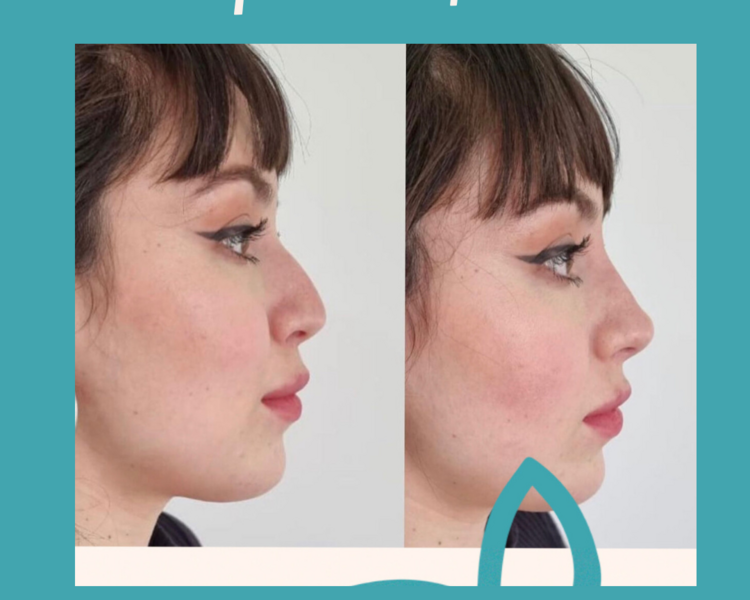 Clinica Niiv Talca | 3 ml de acido hialuronico $210.000 (pago web), 3 ml de acido hialuronico ...